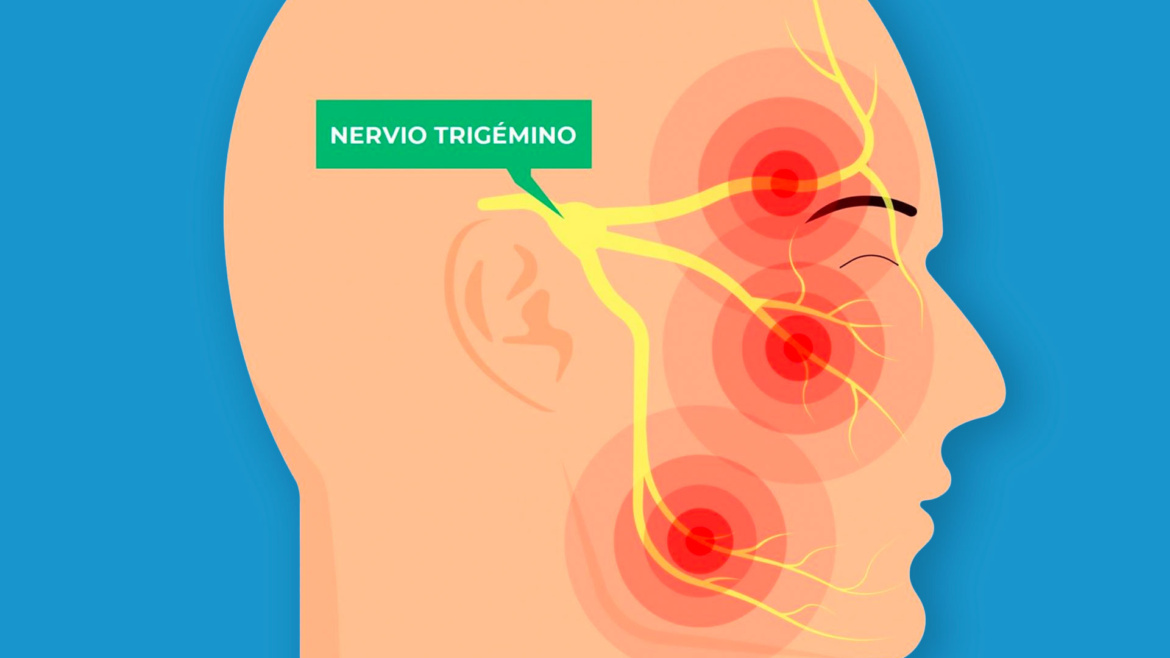 Neuralgia del Trigémino – Dr. Radovan Sancevic