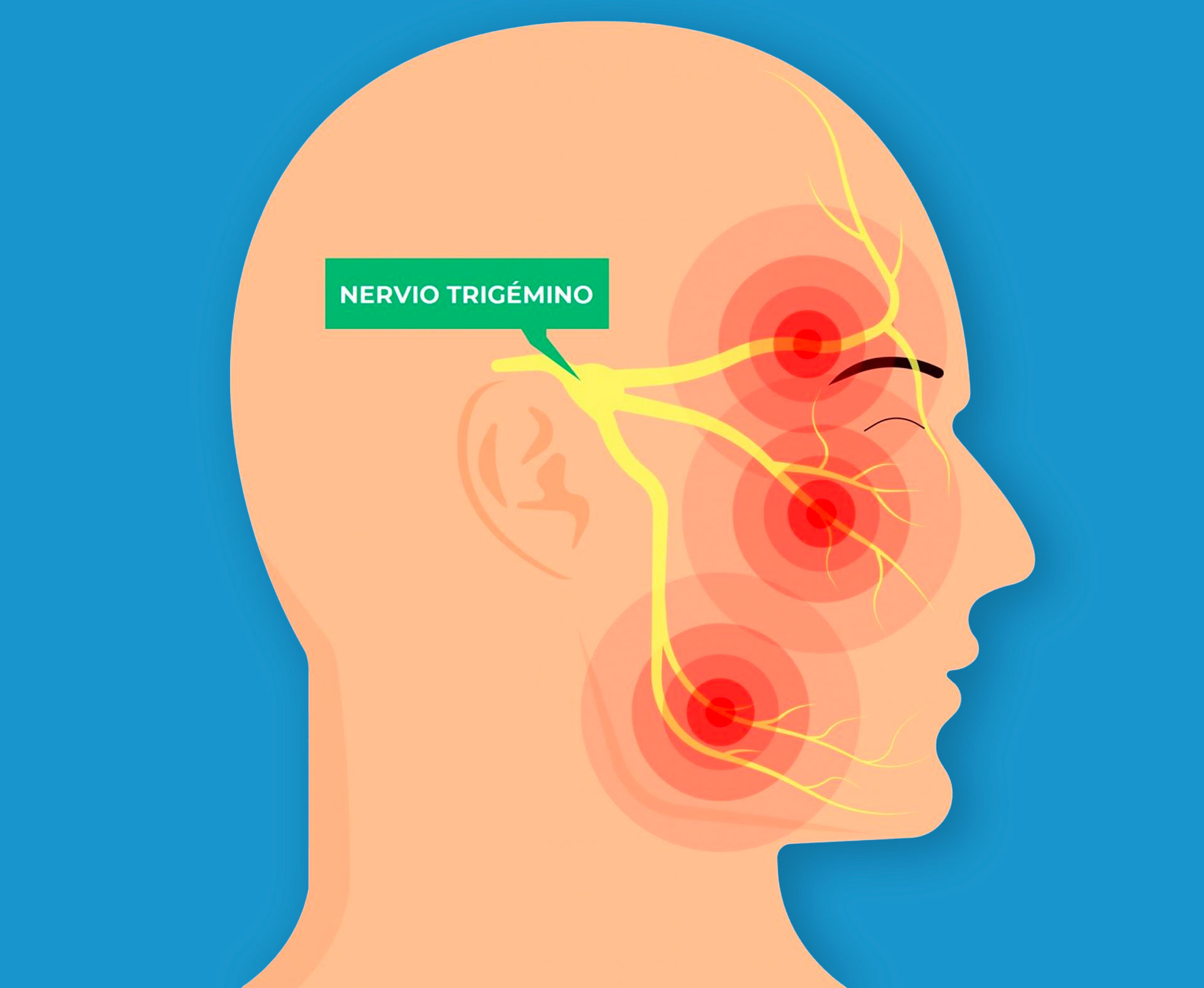 neuralgia-del-trig-mino-dr-radovan-sancevic